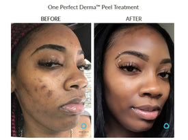 Before And After The Perfect Dermapeel Treatement – The Perfect Derma Peel